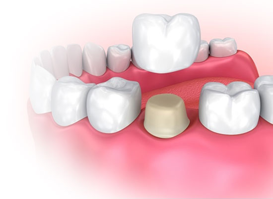 Dental Crowns Hialeah, FL - Life Smile Dental Office