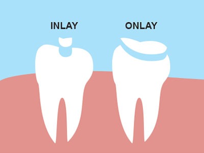 Dental Inlay or Onlay Hialeah, FL - Life Smile Dental Office